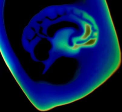 Brain Damage/Brain Injury