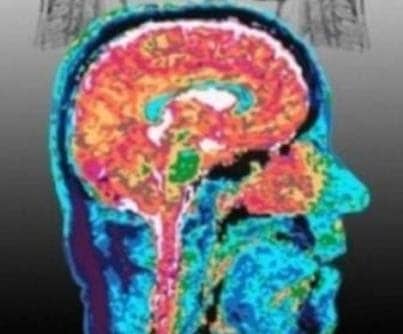 Hypoxic-Anoxic Brain Injury