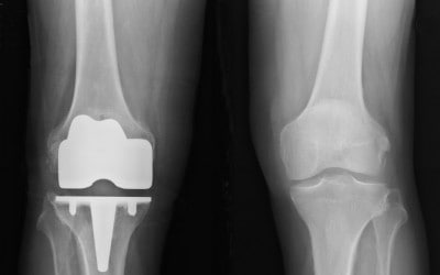 Prosthetic Knee Failure